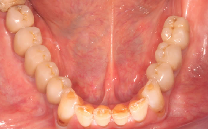 Before and After Gallery | Street Lane Dental Implant Clinic, Leeds